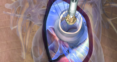 HTG | Aortenklappe | Universitätsmedizin Göttingen
