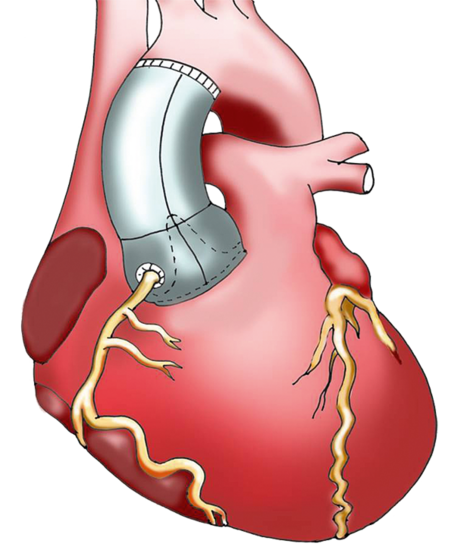HTG | Aortenchirurgie | Universitätsmedizin Göttingen